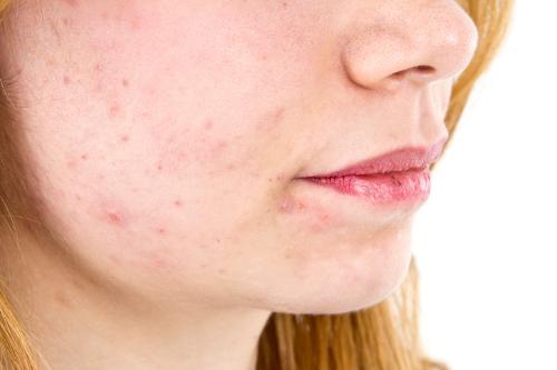 SKIN RASHES ON FACE CAUSES AND TREATMENT